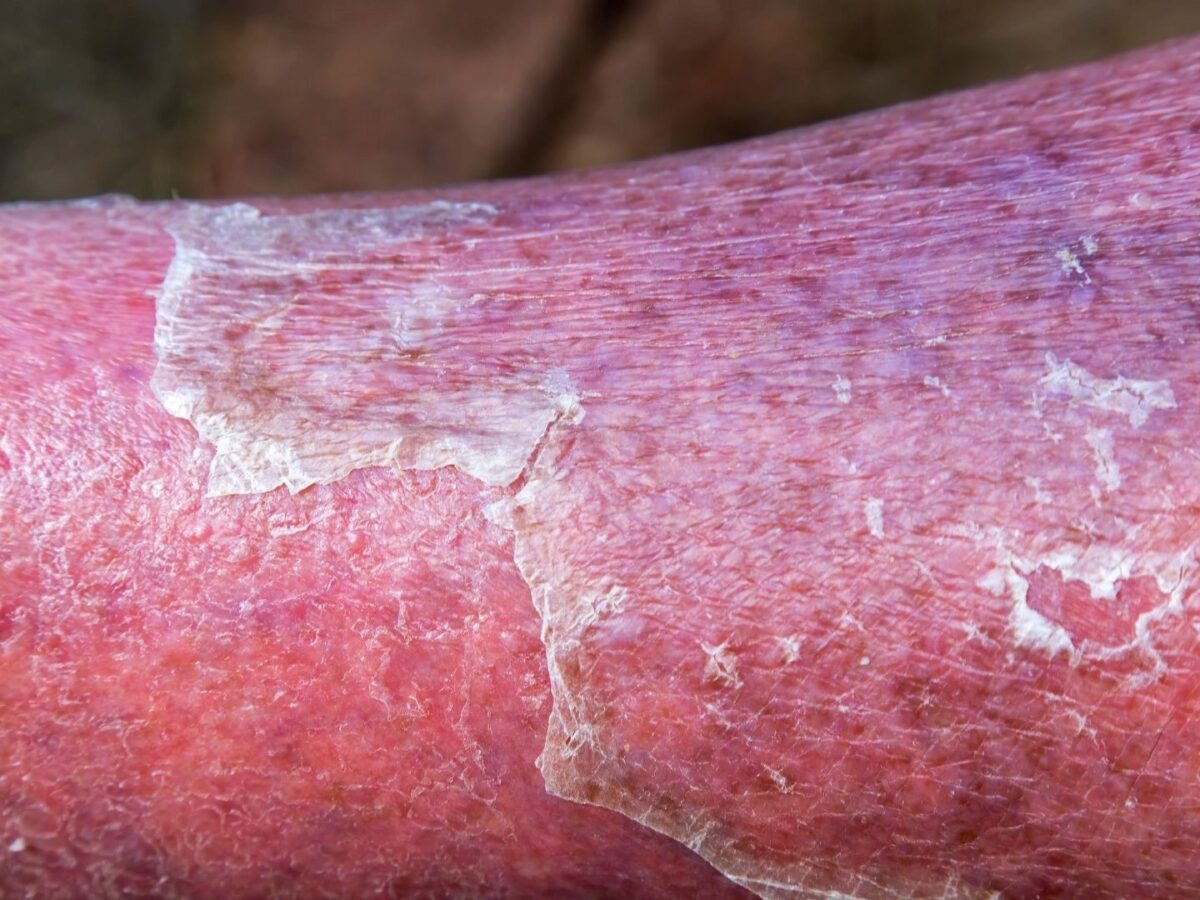 Staph Infection (Staphylococcus aureus bacterium) Archives - Elite ...